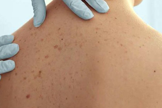 Dangerous skin tumor now has treatment guidelines - Northwestern Now