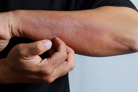 How much does it itch? - Northwestern Now