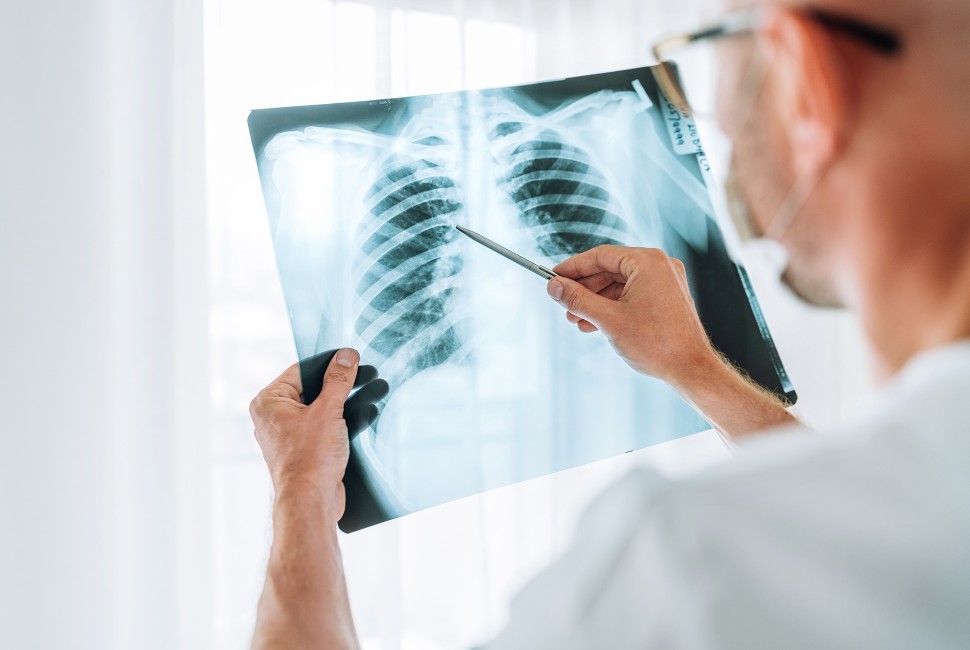 New gene target for aggressive lung cancer discovered - Northwestern Now